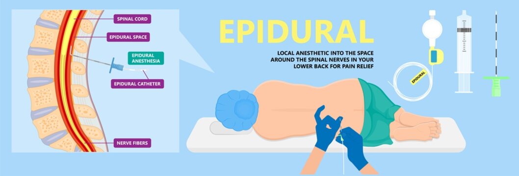 "Spinal Anesthesia" Bilder – Durchsuchen 496 Archivfotos ...