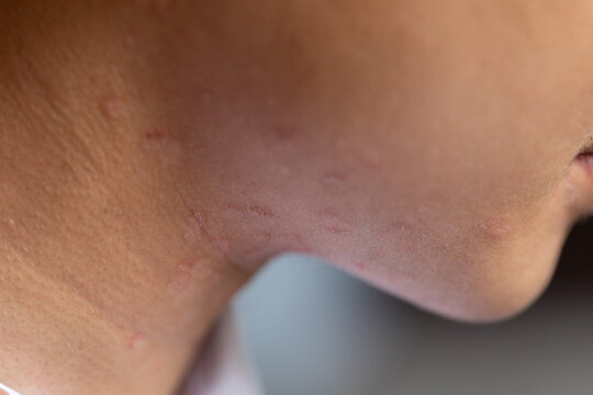 รูปภาพDermatophytosis – เลือกดูภาพถ่ายสต็อก เวกเตอร์ และวิดีโอ8,199 ...