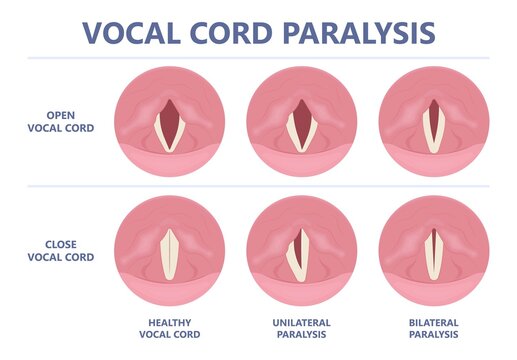 Vocal Cords Damaged