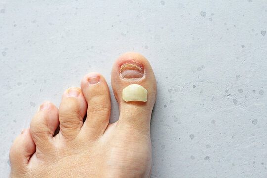 Broken Toenail