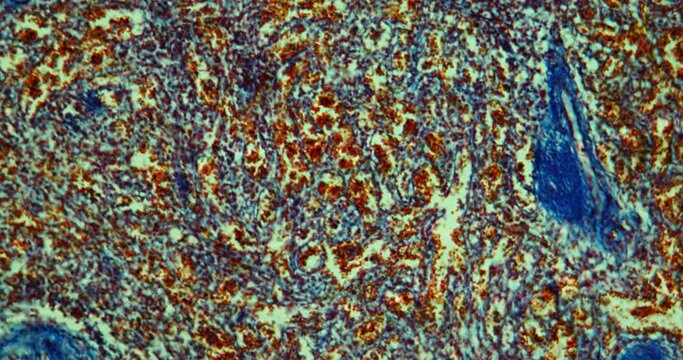 รูปภาพInfarction – เลือกดูภาพถ่ายสต็อก เวกเตอร์ และวิดีโอ41,095 | Adobe ...