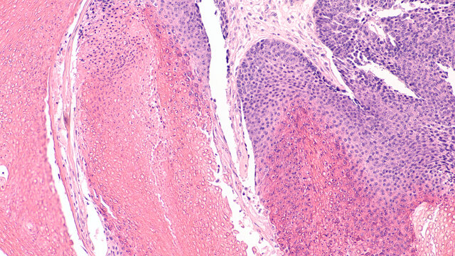 Imágenes de Epithelioma: descubre bancos de fotos, ilustraciones ...
