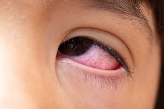 Blefarit bilder – Bläddra bland 1,121 stockfoton, vektorer och videor ...