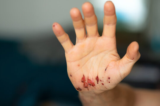 Hand Injury"」の写真素材 | 1,596件の無料イラスト画像 | Adobe Stock