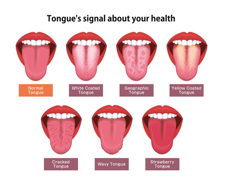 Zungenkrebs Bilder – Durchsuchen 1,037 Archivfotos, Vektorgrafiken und ...