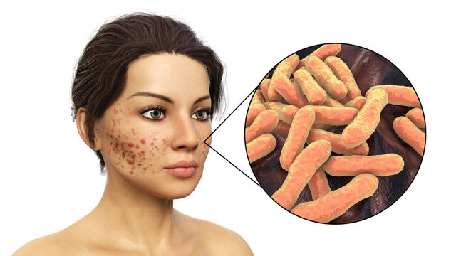 Imagens de Microcomedones – Explore Fotografias do Stock, Vetores e ...