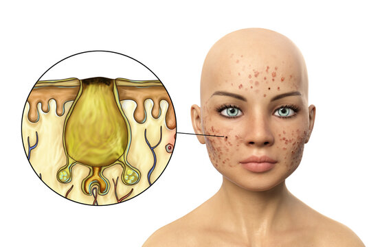 Imagens de Microcomedones – Explore Fotografias do Stock, Vetores e ...