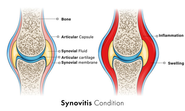 Active Synovitis