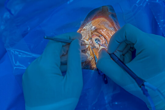 รูปภาพPhaco – เลือกดูภาพถ่ายสต็อก เวกเตอร์ และวิดีโอ331 | Adobe Stock