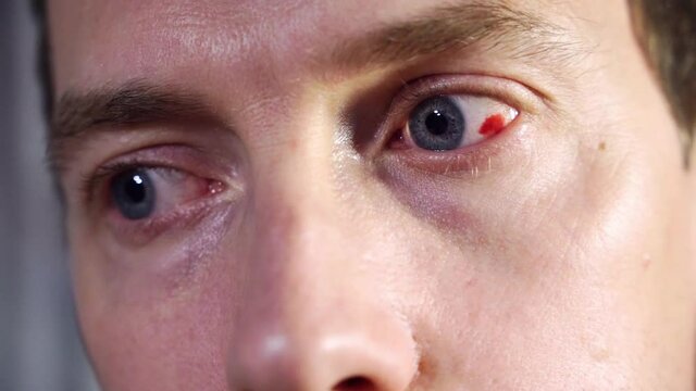 Eye Damage Images – Browse 23,473 Stock Photos, Vectors, and Video ...