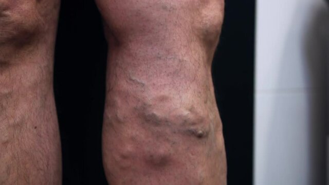 Flebite Imagens – Procure 2,244 fotos, vetores e vídeos | Adobe Stock