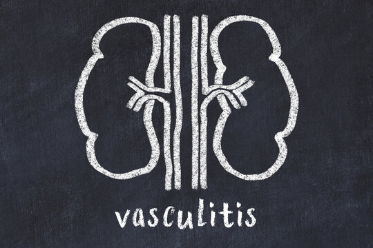 Vasculitis Billeder – Gennemse 1,011 stockfotos, vektorer og videoer ...