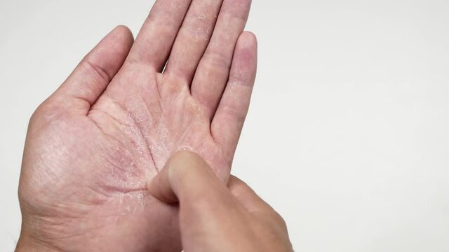 "Cracked Skin" Images – Browse 49,413 Stock Photos, Vectors, and Video ...