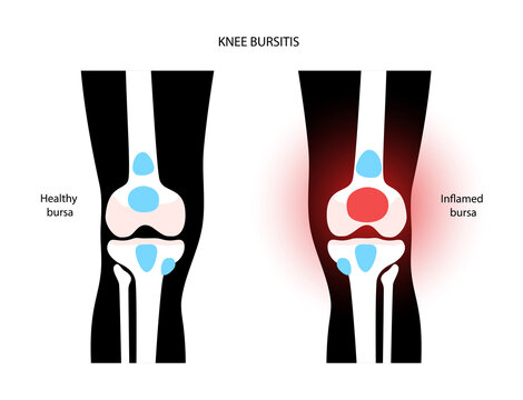 รูปภาพSuprapatellar – เลือกดูภาพถ่ายสต็อก เวกเตอร์ และวิดีโอ61 | Adobe ...