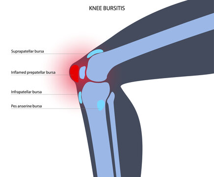 รูปภาพSuprapatellar – เลือกดูภาพถ่ายสต็อก เวกเตอร์ และวิดีโอ61 | Adobe ...