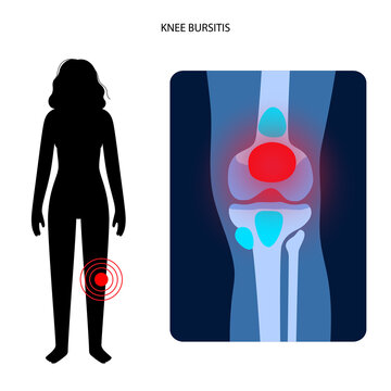 รูปภาพSuprapatellar – เลือกดูภาพถ่ายสต็อก เวกเตอร์ และวิดีโอ61 | Adobe ...