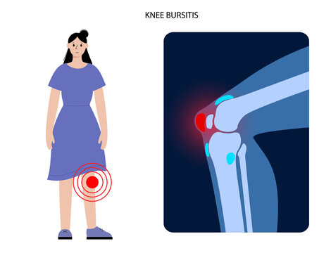 รูปภาพSuprapatellar – เลือกดูภาพถ่ายสต็อก เวกเตอร์ และวิดีโอ61 | Adobe ...