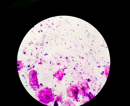 Staphylococcus Aureus Gram Stain 100x