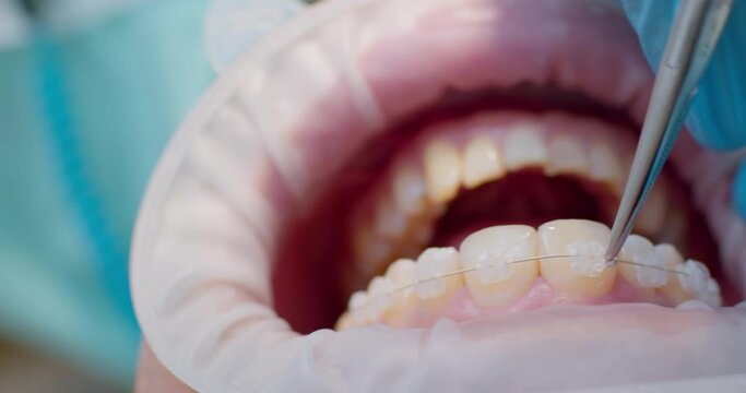 "Dental Forceps" Images – Browse 232 Stock Photos, Vectors, and Video ...