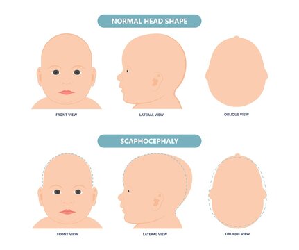 รูปภาพAnencephalus – เลือกดูภาพถ่ายสต็อก เวกเตอร์ และวิดีโอ101 | Adobe ...