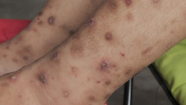 Scabies Rash On Thighs