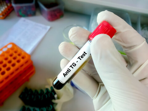 Anti-Thyroid Images – Browse 84 Stock Photos, Vectors, and Video ...