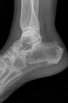 Calcaneal Spur Xray