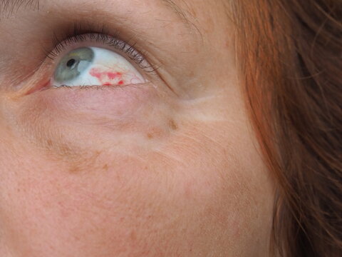 137 BEST Subconjunctival IMAGES, STOCK PHOTOS & VECTORS | Adobe Stock