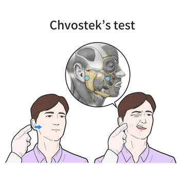 Chvostek - Images et vidéos libres de droits | Adobe Stock