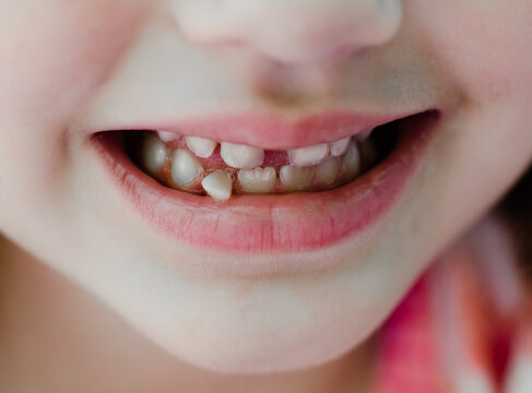 "Loose Tooth" Images – Browse 338 Stock Photos, Vectors, and Video ...