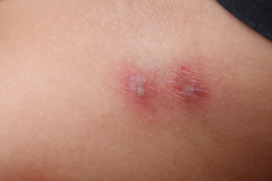 Shingles Rash Images – Browse 2,101 Stock Photos, Vectors, and Video ...