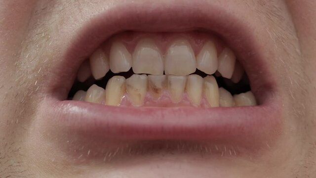 "Rotten Teeth" Images – Browse 76 Stock Photos, Vectors, and Video ...