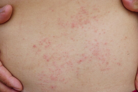 「Atopy」の画像 - 706 件の Stock 写真、ベクターおよびビデオ | Adobe Stock