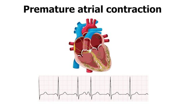 รูปภาพArrhythmia – เลือกดูภาพถ่ายสต็อก เวกเตอร์ และวิดีโอ11,201 | Adobe ...