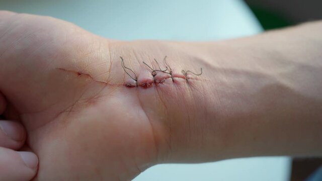 Cut Wrist Stitches