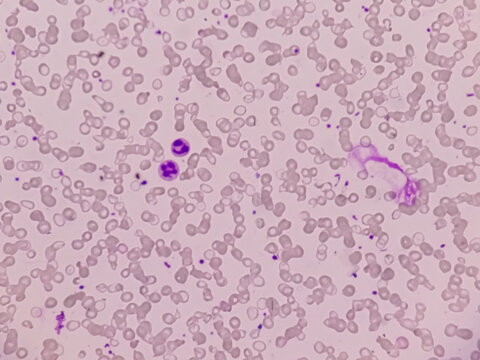 Ovalocytes Images – Browse 74 Stock Photos, Vectors, and Video | Adobe ...
