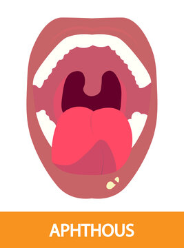 รูปภาพAphthous – เลือกดูภาพถ่ายสต็อก เวกเตอร์ และวิดีโอ361 | Adobe Stock