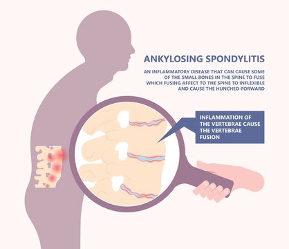 Spondylarthrose-Bilder: Stock-Fotos & -Videos. | Adobe Stock