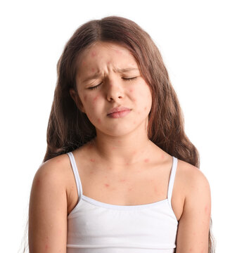 Waterpox Billeder – Gennemse 245 stockfotos, vektorer og videoer ...