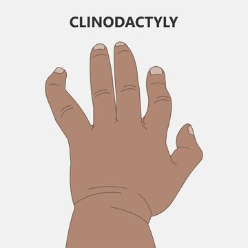 รูปภาพSyndactyly – เลือกดูภาพถ่ายสต็อก เวกเตอร์ และวิดีโอ85 | Adobe Stock