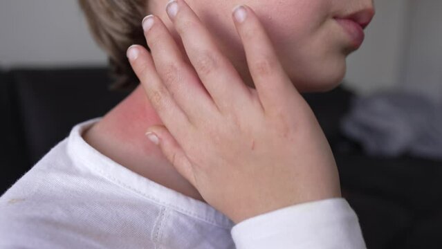 Obrázky Photodermatitis – procházejte fotografie, vektory a videa 286 ...