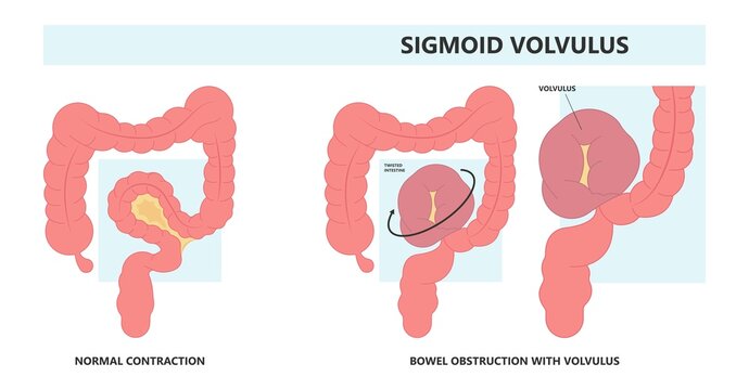 รูปภาพMegacolon – เลือกดูภาพถ่ายสต็อก เวกเตอร์ และวิดีโอ104 | Adobe Stock