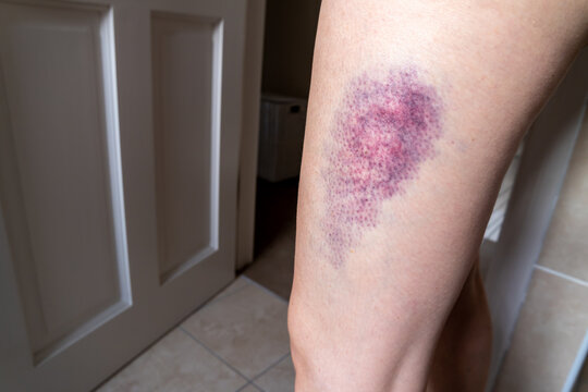 Blue(Bruise) Bilder – Durchsuchen 4,116 Archivfotos, Vektorgrafiken und ...