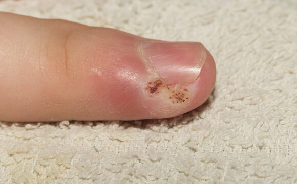 Finger Infection Felon