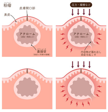 Atherom Bilder – Durchsuchen 2,359 Archivfotos, Vektorgrafiken und ...