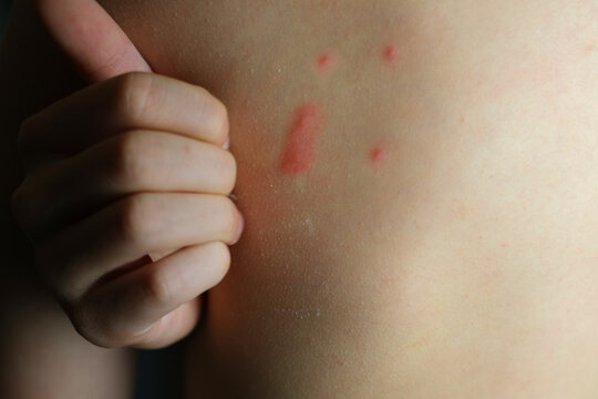 「Papules」の画像 - 3,212 件の Stock 写真、ベクターおよびビデオ | Adobe Stock