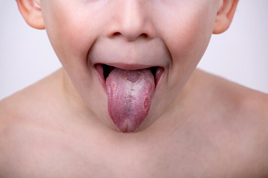 Glossitis Bilder Stock Fotos Videos Adobe Stock