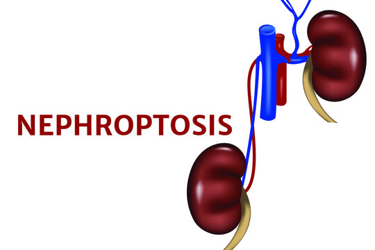 Nephroptosis bilder – Bläddra bland 197 stockfoton, vektorer och videor ...