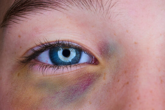 Blue(Bruise) Bilder – Durchsuchen 3,632 Archivfotos, Vektorgrafiken und ...