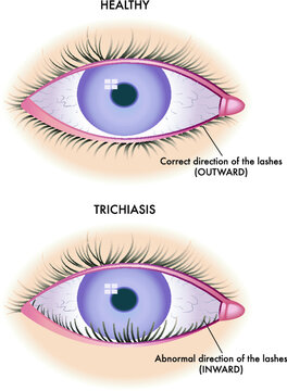 Bindehautsack Bilder – Durchsuchen 1,280 Archivfotos, Vektorgrafiken ...